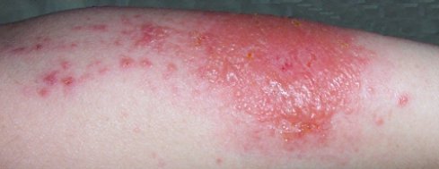 Contact Dermatitis, Scabies, Staph, Strep, or MRSA. Name that Rash.